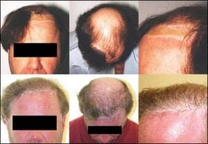 Scalp Reconstruction: An Aesthetic Challenge - Plastic Surgery Practice