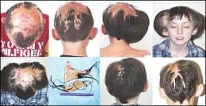 Scalp Reconstruction: An Aesthetic Challenge - Plastic Surgery Practice