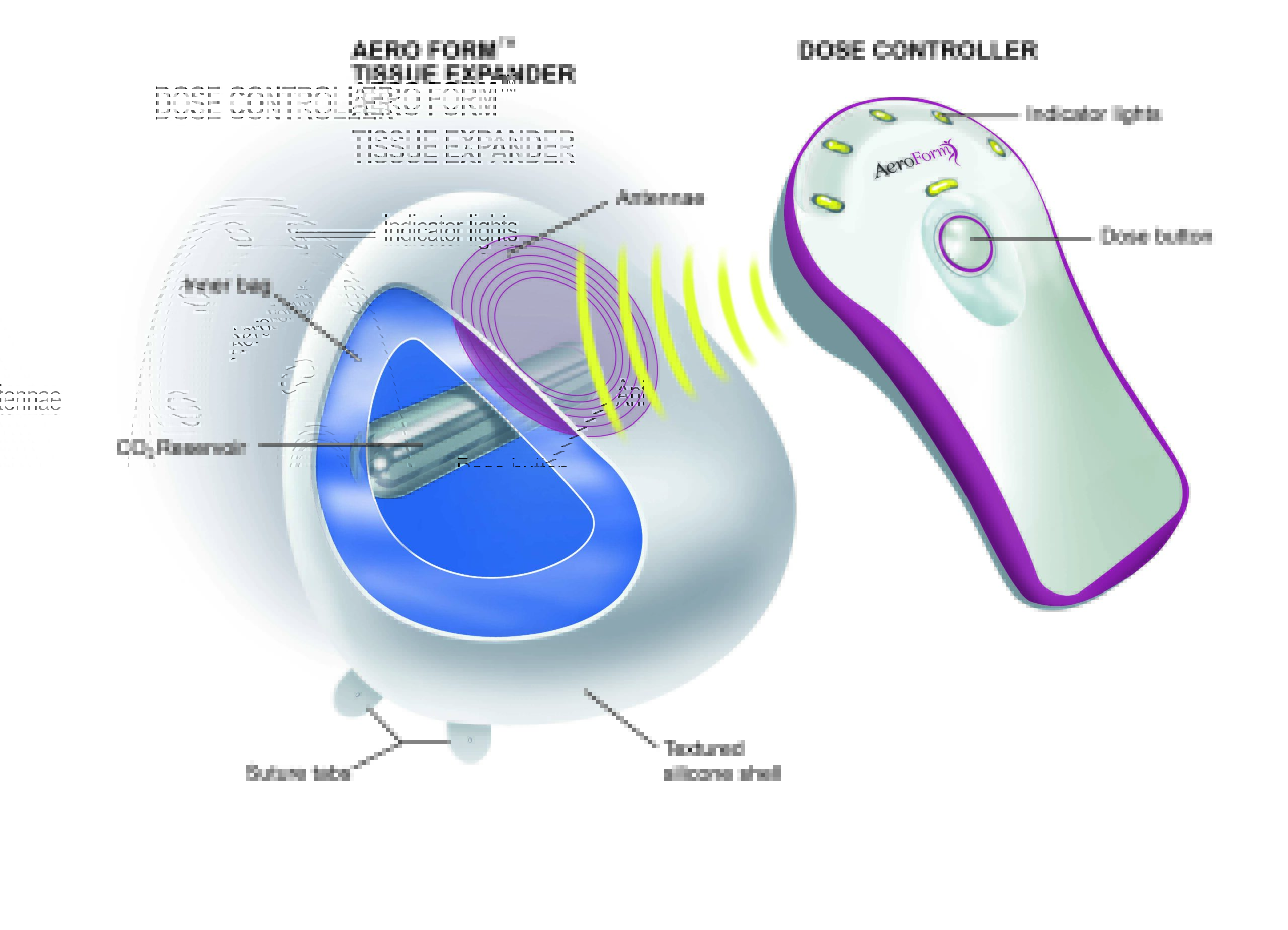 AirXpanders Inc Aeroform Decreases Time to Breast Reconstruction ...