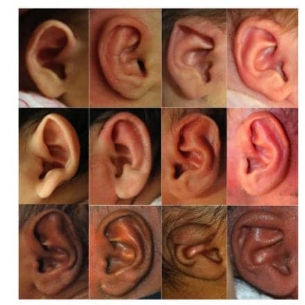 Nonsurgical Procedure Quickly and Effectively Corrects Newborn Ear ...