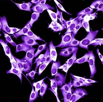 New Melanoma Treatment Target: GMPS - Plastic Surgery Practice