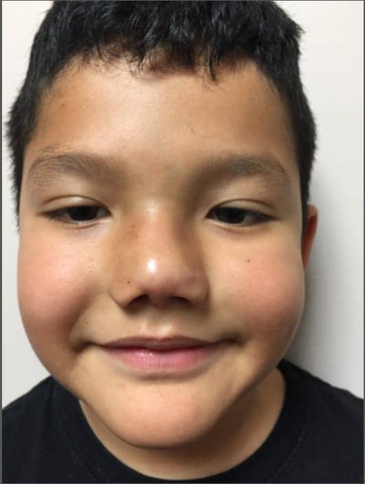 Pro Bono Surgery from AAFPRS Surgeon Helps Boy Overcome Bullying ...