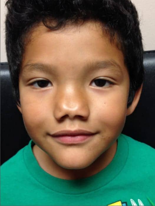 Pro Bono Surgery from AAFPRS Surgeon Helps Boy Overcome Bullying ...