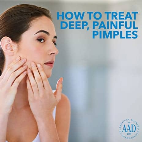 American Academy of Dermatology's Advice to Patients with Pimples ...