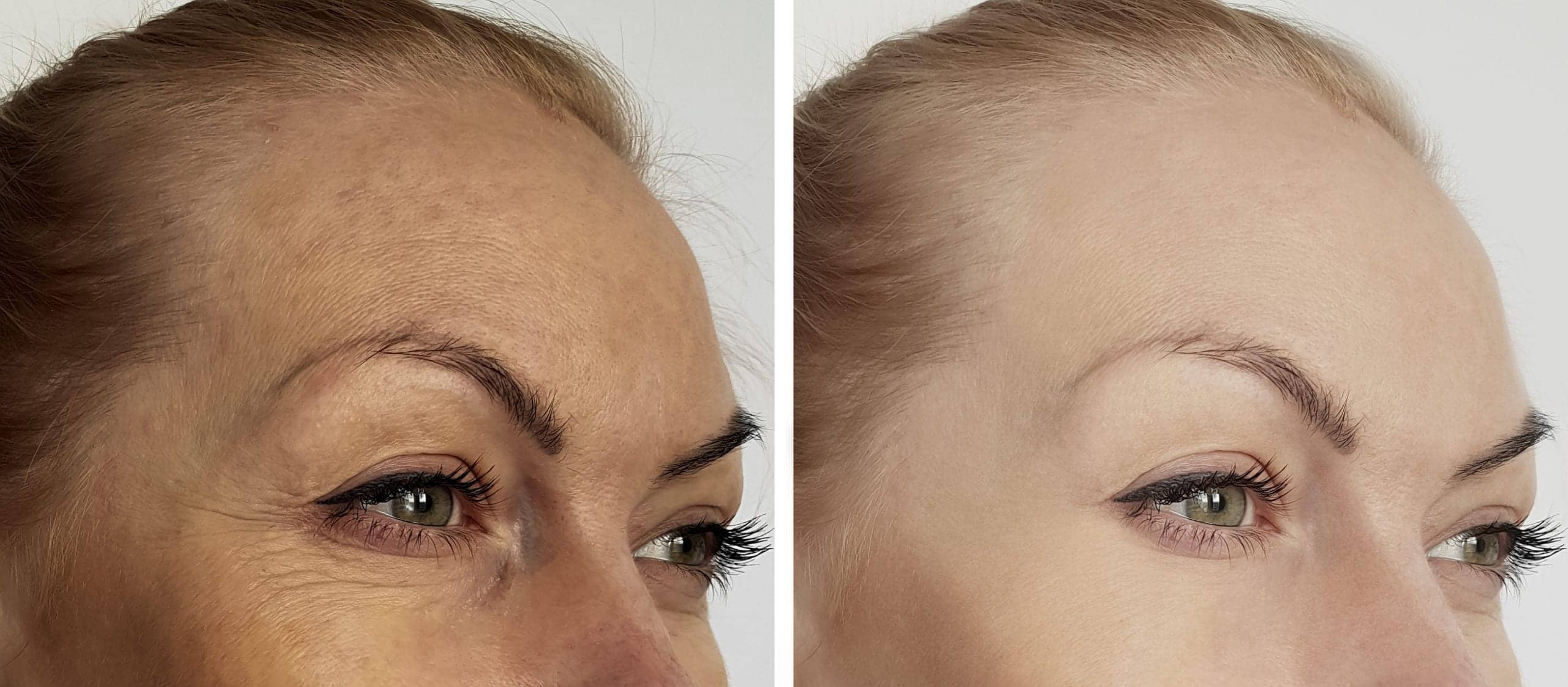 Neauvia’s Plasma IQ Device Is the First and Only FDA Class II Cleared ...