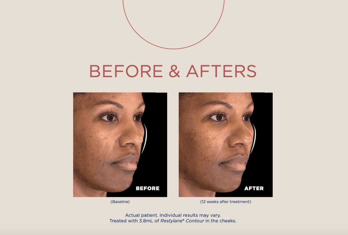 FDA Approves Restylane Contour - Plastic Surgery Practice