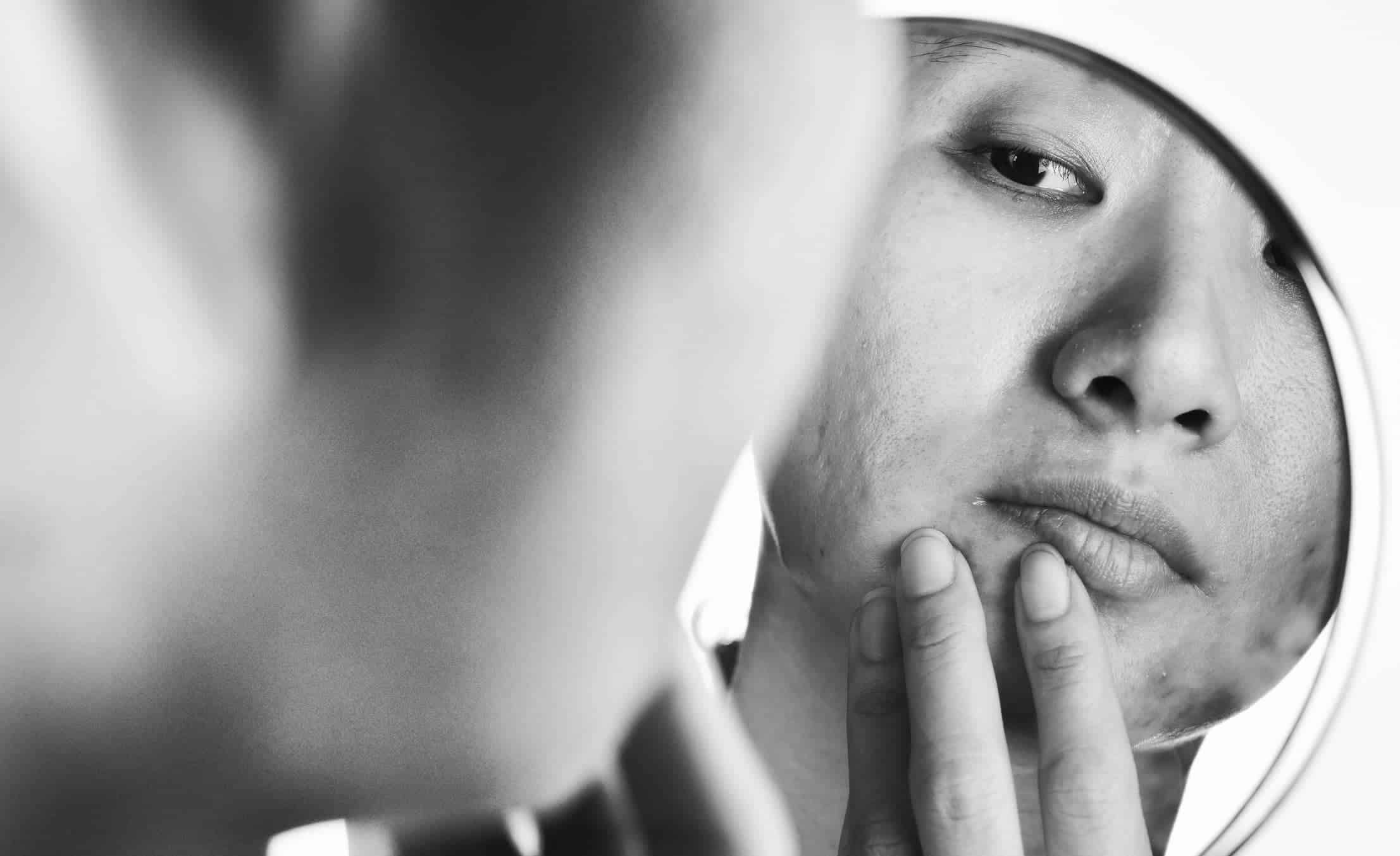 Study Patients Rate Surgical Facial Scars More Critically Than Others Study Patients Rate Surgical Facial Scars More Critically Than Others