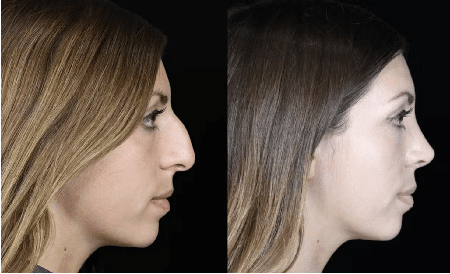 Nerve Block Innovation: Reducing Pain in Rhinoplasty - Plastic Surgery ...