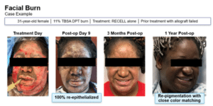 RECELL for Acute Wound Care and Reconstruction