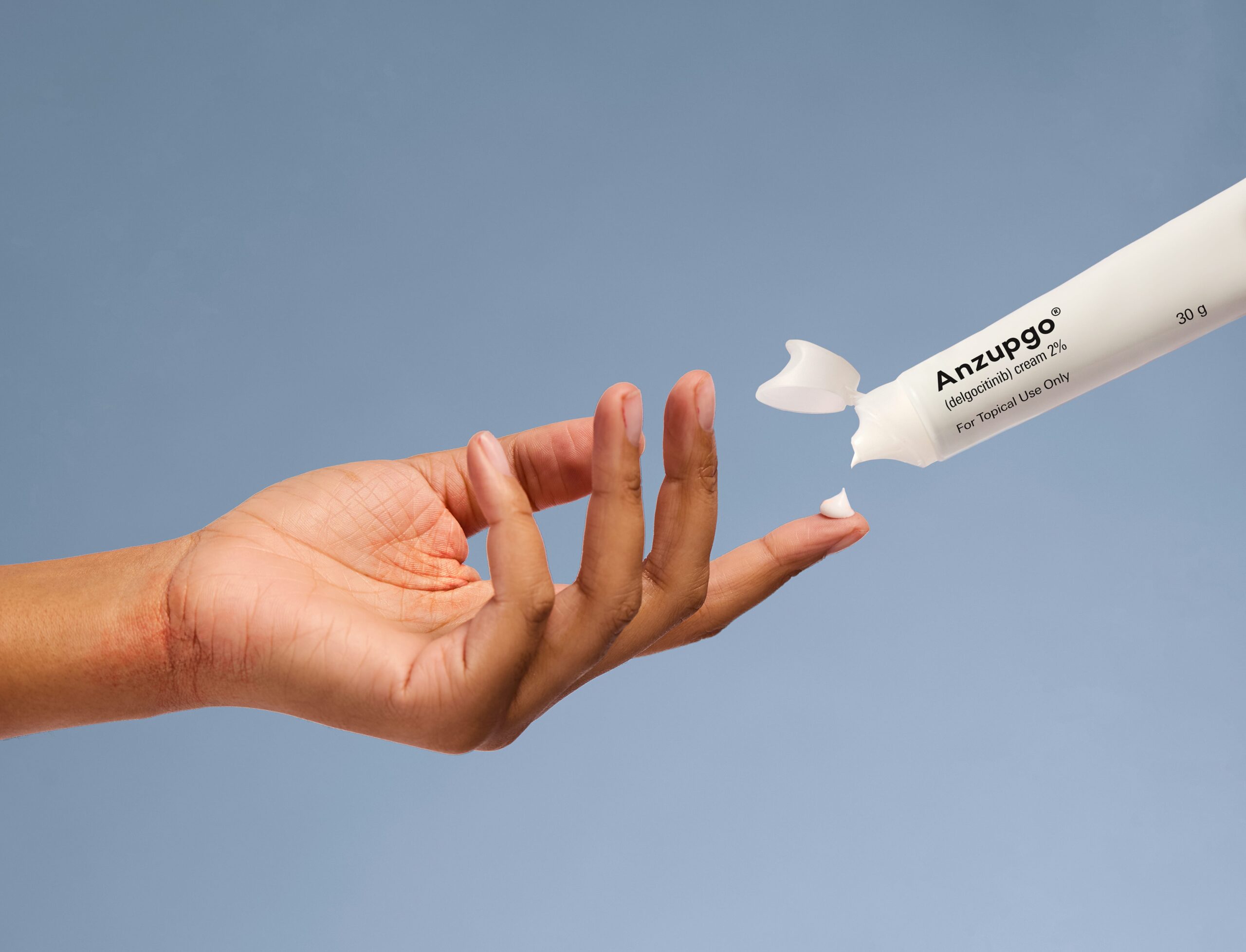 FDA Approves Treatment for Moderate-to-Severe Chronic Hand Eczema ...