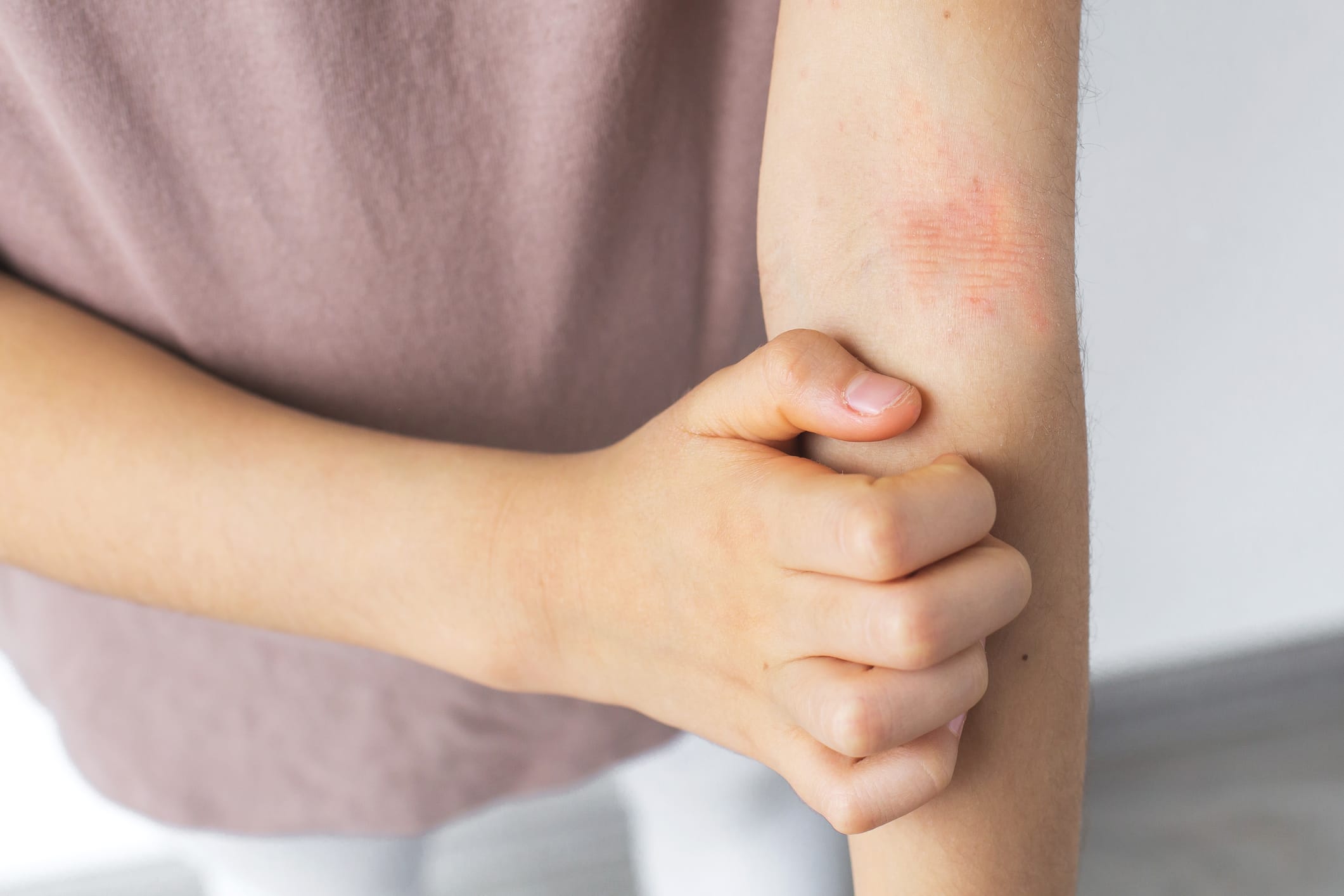 FDA Extends Review of Opzelura for Pediatric Atopic Dermatitis ...