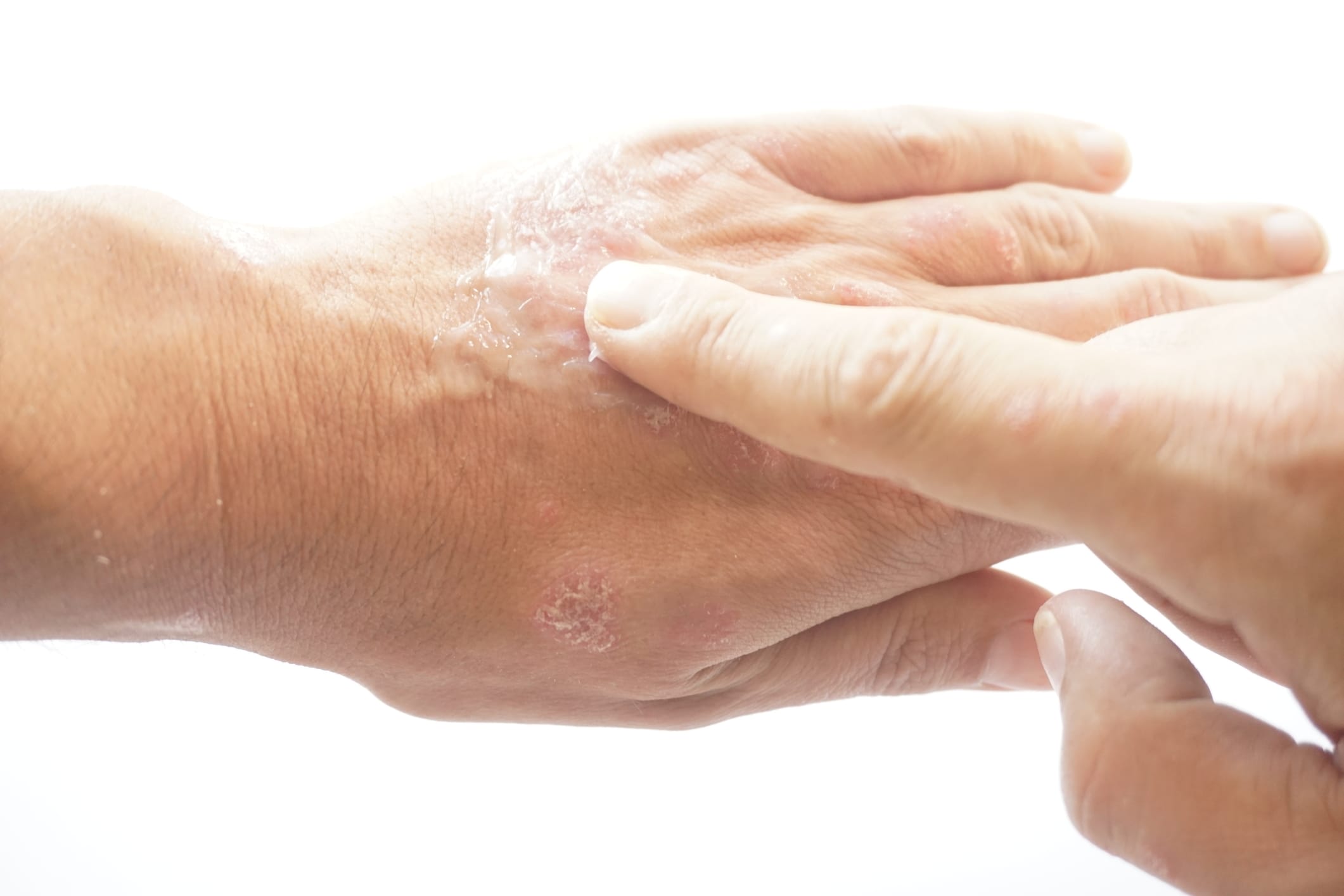 AAD Issues Strong Recommendations for Four Therapies in Updated Atopic ...