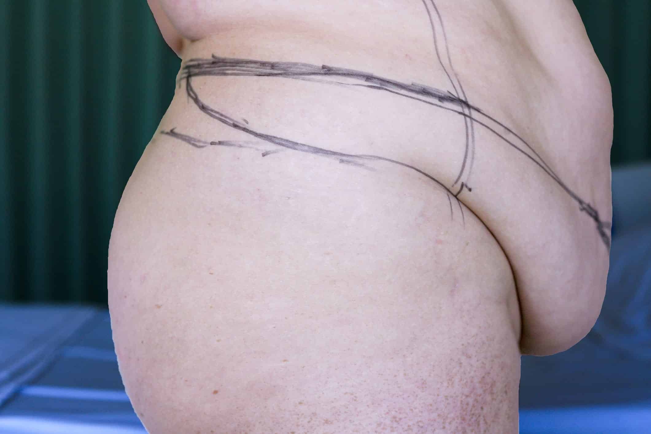 Prior COVID Infection May Raise Blood Clot Risk After Panniculectomy ...
